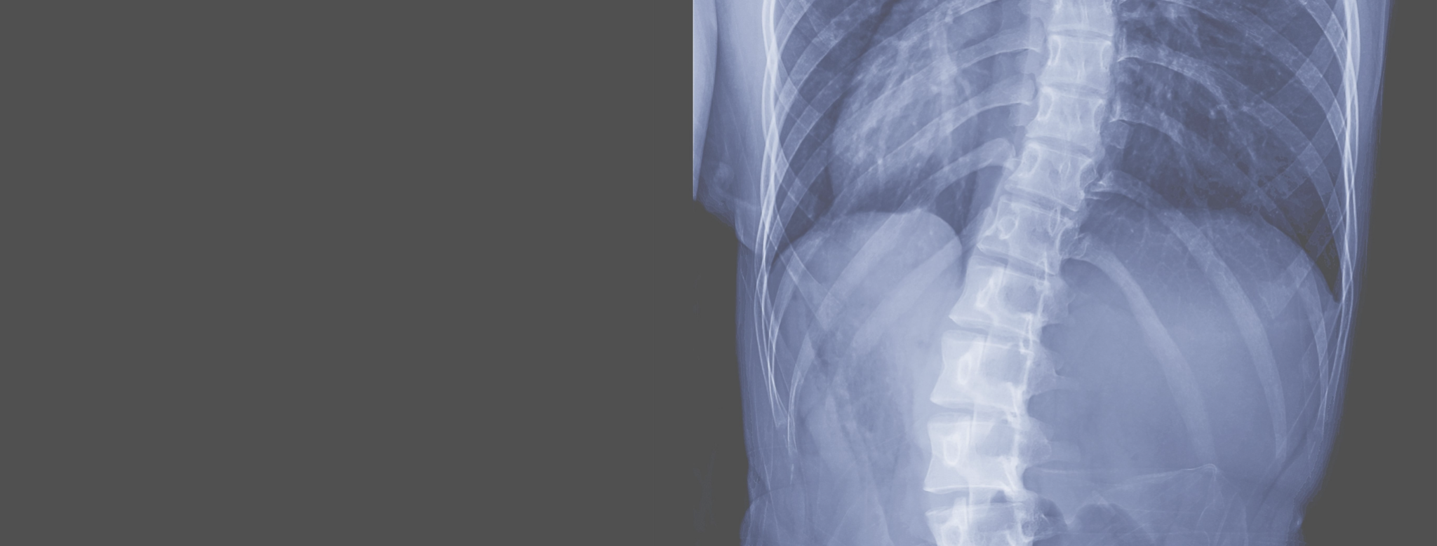 What Is Scoliosis And How We Treat It. - Canberra Physiotherapy clinic ...